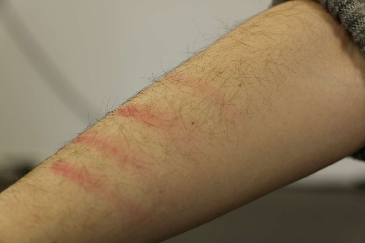 Marques sur les bras